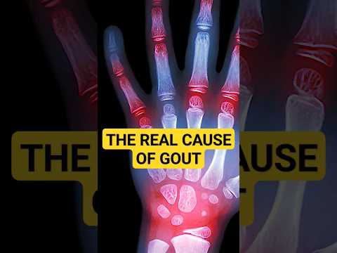 Gout Disease Symptoms Uncovered: Your Tech-Driven Solution