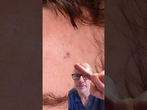Nodular Basal Cell Carcinoma: Advanced Tools for Early Detection